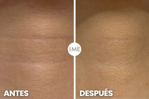 Bótox antes y después ️ Fotos Reales de Pacientes