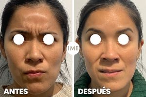 Bótox antes y después ️ Fotos Reales de Pacientes