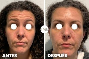 Bótox antes y después ️ Fotos Reales de Pacientes
