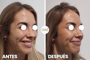 Bótox antes y después ️ Fotos Reales de Pacientes