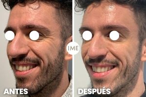 Bótox antes y después ️ Fotos Reales de Pacientes