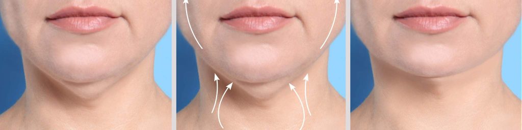 Quitar la papada sin cirugía: ¿Cómo? - Clinica Medicina Estetica IME